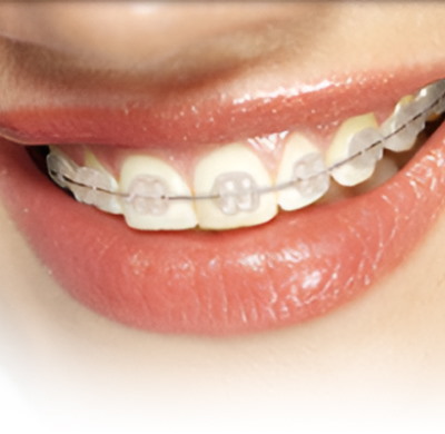 Types of Braces | Wesley E. King, D.D.S., P.A. | King Orthod